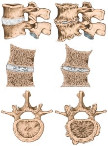 Bone Spurs in Frisco | American Neurospine Institute